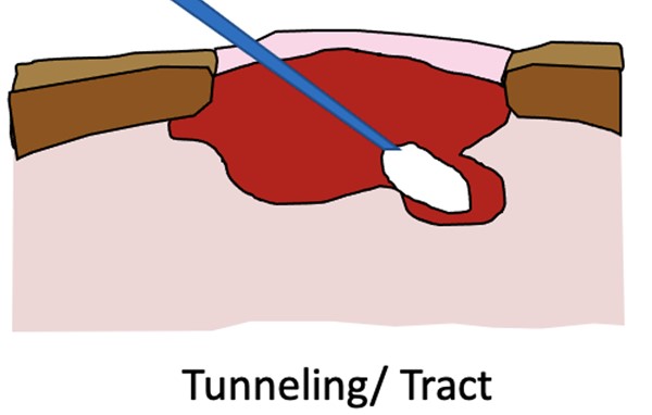 How to Assess a Patient with Chronic Wounds
